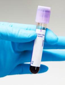 PSA Testing | Partners Imaging Centers | Prostate Cancer Imaging ...